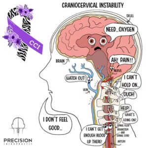Understanding Craniocervical Instability (CCI) - Precision Chiropractic
